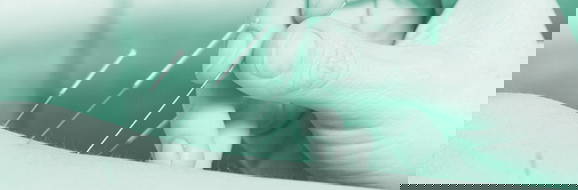 Acupuncture therapy treatment at Stillpoint Osteopaths in Bath